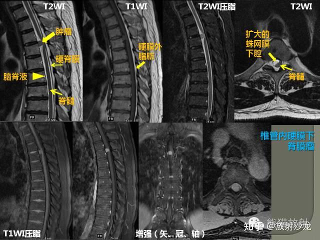 如何简单理解、认识MRI图像 - 知乎