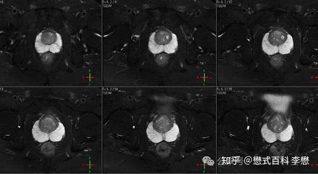 前列腺磁共振中mp-MRI、bp-MRI和abp-MRI - 知乎