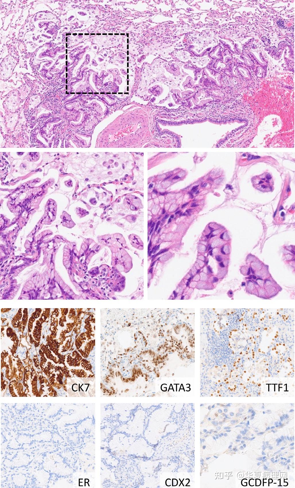 分子时代学病理-GATA3基因 - 知乎