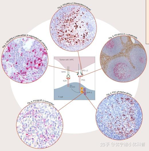 小优进修班∣Naveni® PLA产品效果展示 - 知乎