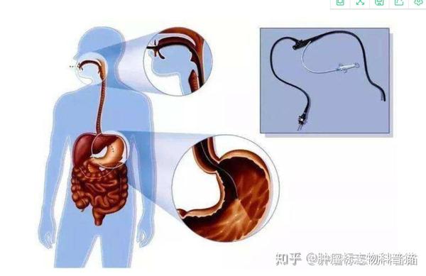 胃镜和肠镜可以一起做吗?做胃镜和做肠镜的流程分别是什么? 知乎