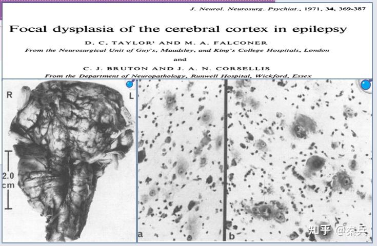 局灶性皮质发育不良Ⅱ（定义和分类） - 知乎