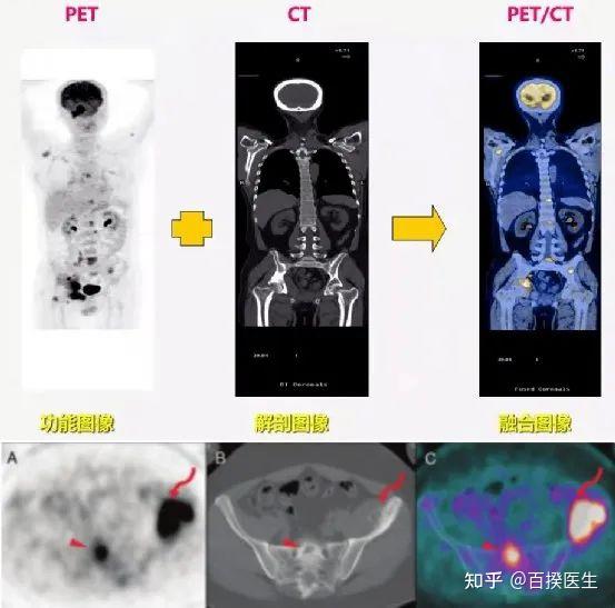 影像科普 | PET-CT检查大揭秘 - 知乎