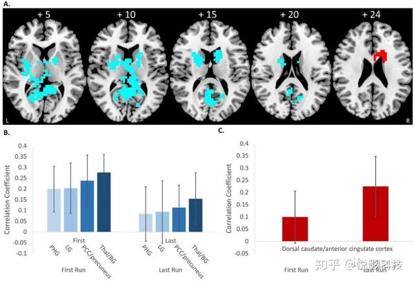 NeuroImage: ADHD青少年右侧额下回皮层fMRI神经反馈的功能连接变化 - 知乎