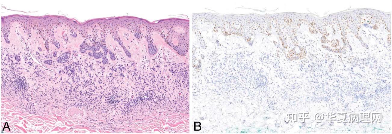 黑素细胞肿瘤诊断中的免疫组化PRAME（一） - 知乎