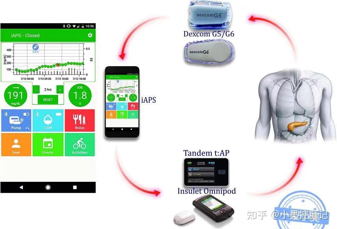 【糖友推荐】开源闭环软件AAPS：为什么越来越多的糖友选择它？ - 知乎