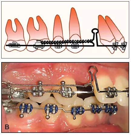 牙齿矫正两年了牙缝还没关上，正常吗？ - 知乎