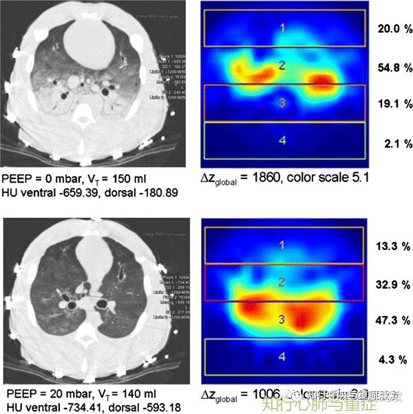 第149期 滴定PEEP的9个方法 - 知乎