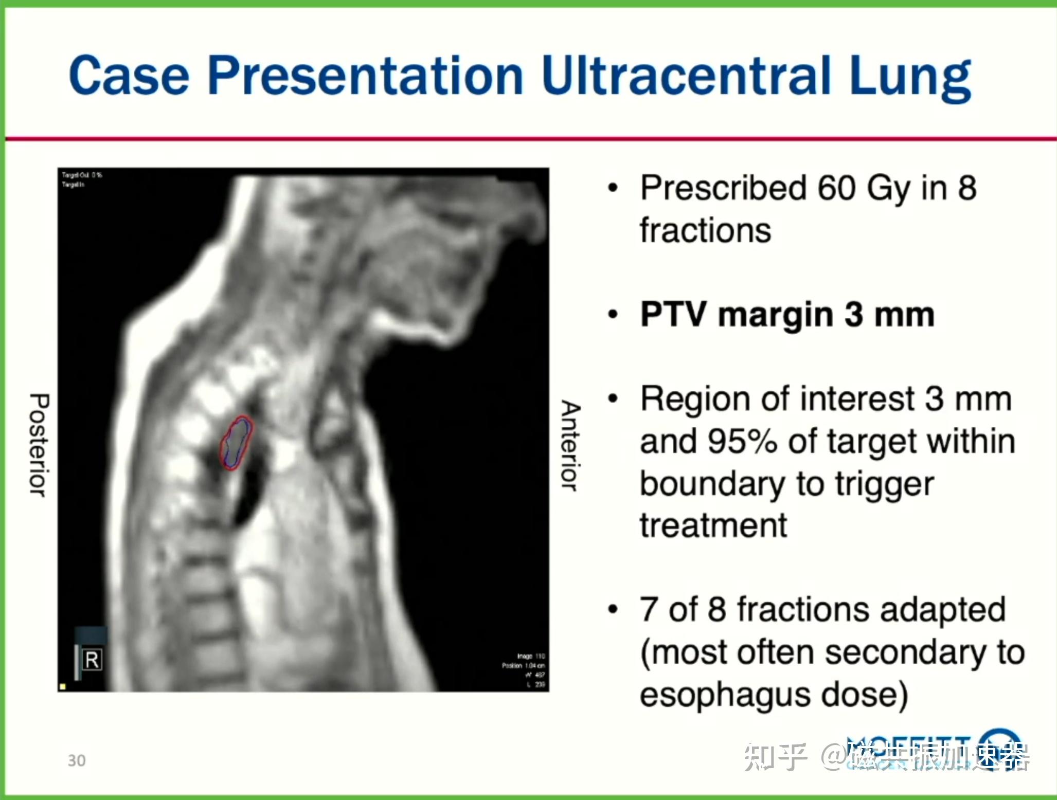 “穿针引线”-磁共振引导的中央、超中央型肺癌放射消融治疗 - ViewRay MRIdian - 知乎