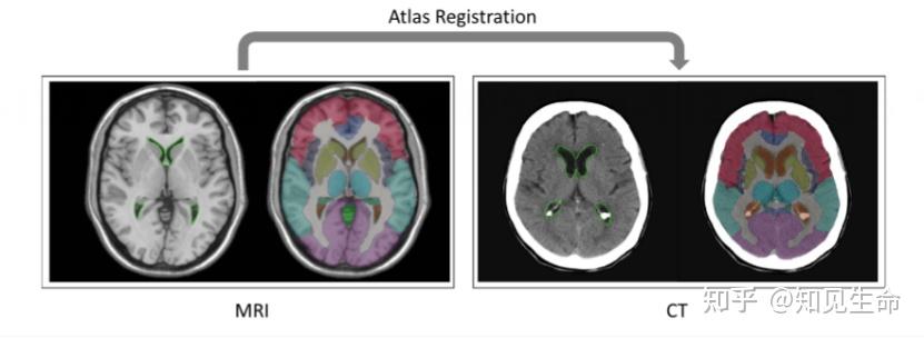 【学术分享第7期】 基于CNNs全自动化大脑结构分割MR-CT多图谱配准 - 知乎