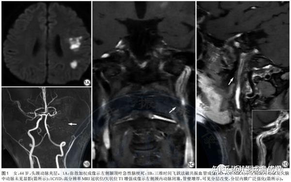 基于高分辨率MRI评估头颈动脉夹层与急性缺血性脑卒中的关系 - 知乎