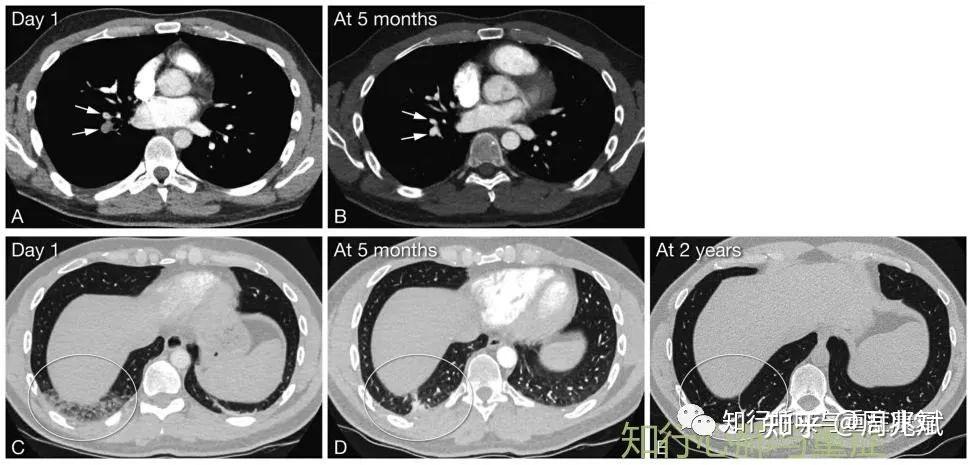 肺栓塞的病理生理及诊断依据（附指南） - 知乎