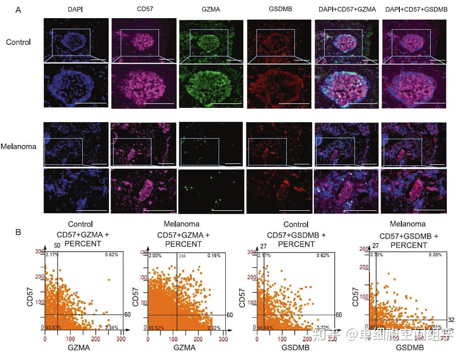 临床介导的 CD8+ T 细胞和 NK 细胞焦亡的发现揭示了黑色素瘤异质性 - 知乎