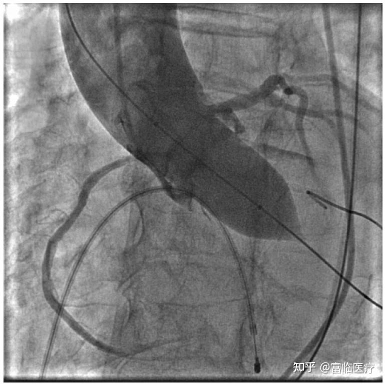 球囊主动脉瓣成形术 - 知乎