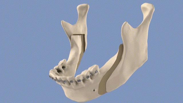 正颌手术都有哪些术式？这组动图让你一目了然！ - 知乎