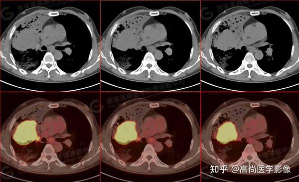 PET/CT病例：肺鳞癌5例【高尚医学影像】 - 知乎
