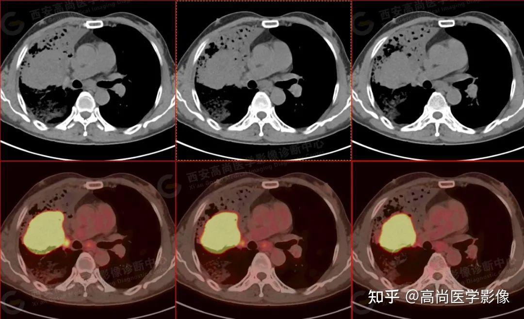 PET/CT病例：肺鳞癌5例【高尚医学影像】 - 知乎
