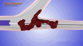 械企风云 | 血管介入治疗行家Inari Medical - 知乎