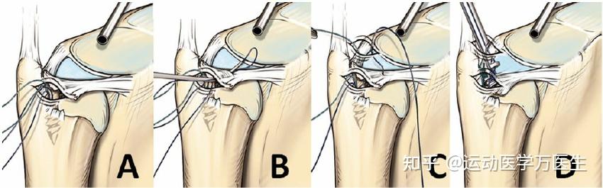 运动后手腕疼？可能里面的小软骨（TFCC）破了 - 知乎