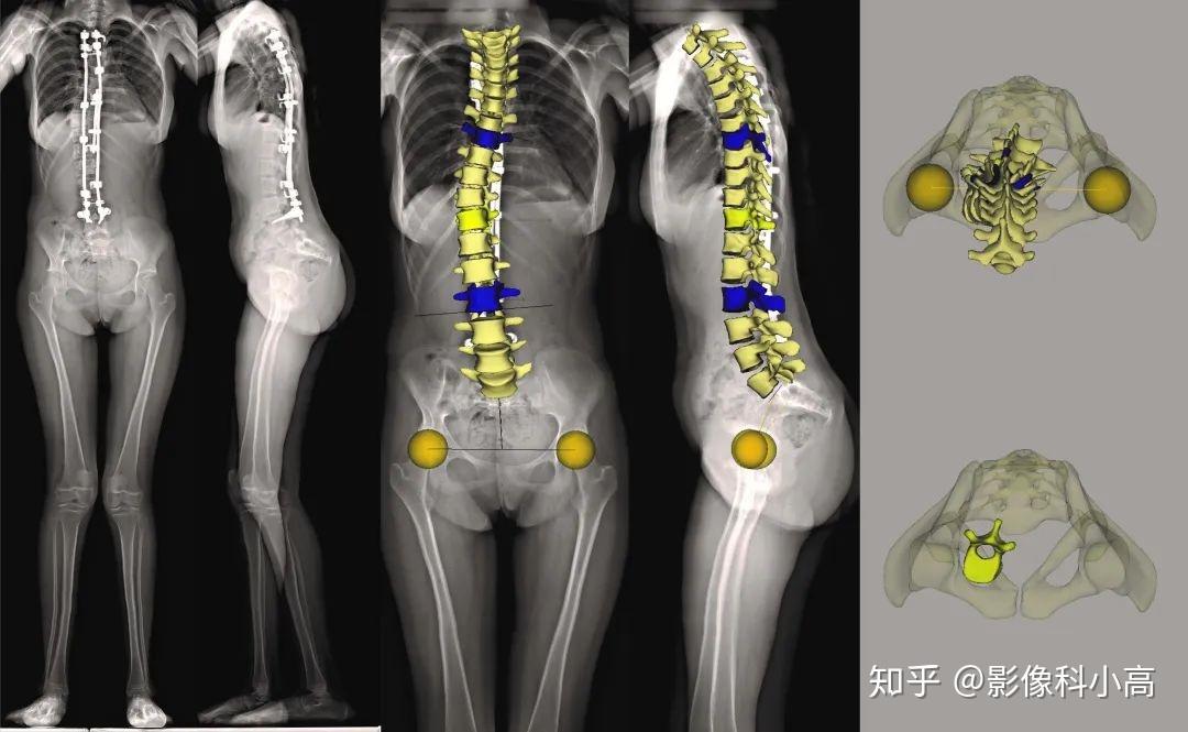 EOS®全身三维成像系统 - 知乎