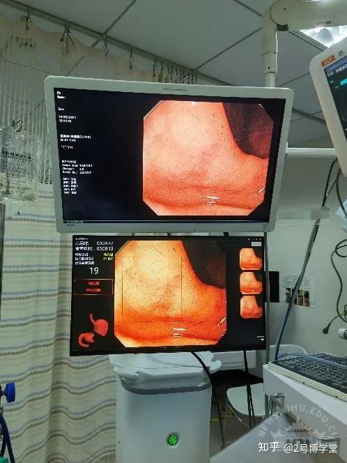 生物医药AI | AI辅助内镜检查可降低近八成胃肿瘤漏检风险 - 知乎