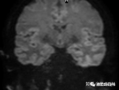 DWI-TSE无形变扩散成像 - 知乎