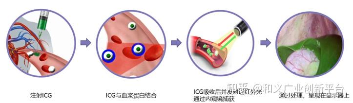 荧光电子内窥镜1——了解荧光电子内窥镜原理及组成，这一篇就够了！ - 知乎