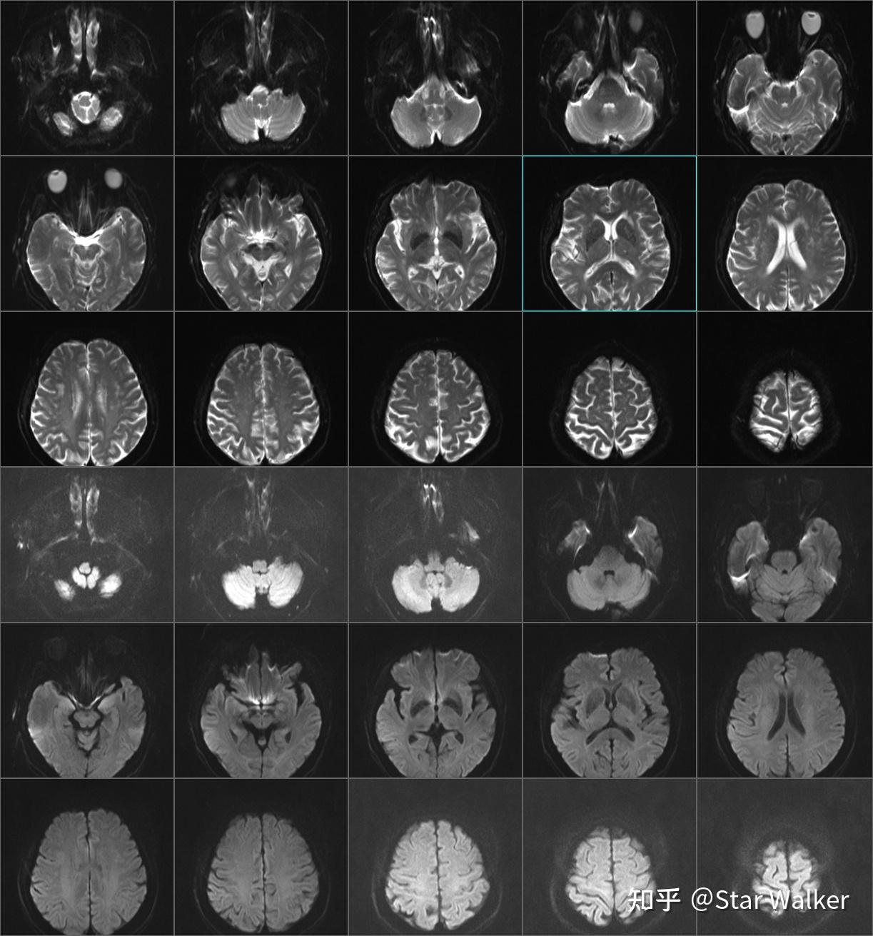 用MeVisLab来计算ADC值，并做对比（上） - 知乎