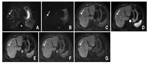 MRU磁共振泌尿系统成像技术及扫描规范