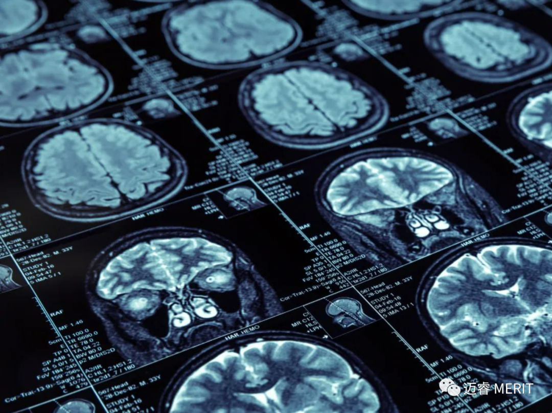 胶质母细胞瘤疗法的最新进展 - 知乎