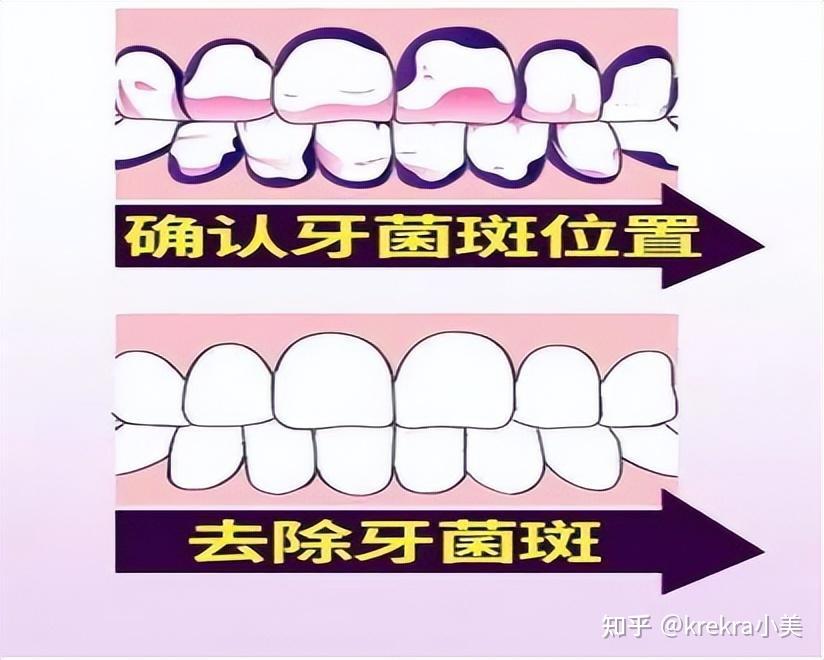风靡日韩欧美的口腔保健PMTC是什么？ - 知乎