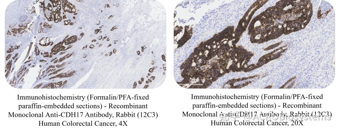 CDH17靶向药物崛起：IHC验证驱动消化道癌治疗突破 - 知乎