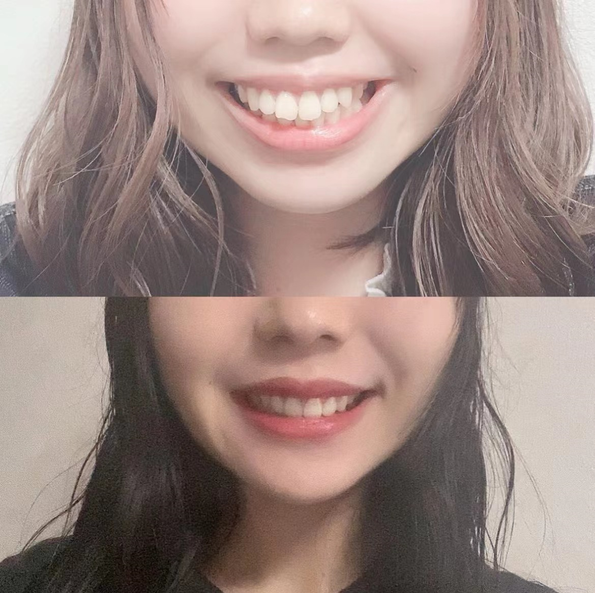 vvsmile隐形矫正能改变脸型吗？这三种变化太大了 - 知乎