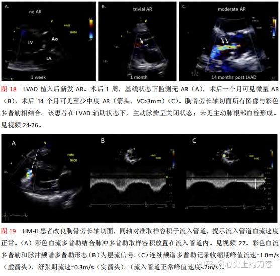 美国超声心动图学会指南及标准超声心动图在左心室辅助装置管理中的应用 - 知乎