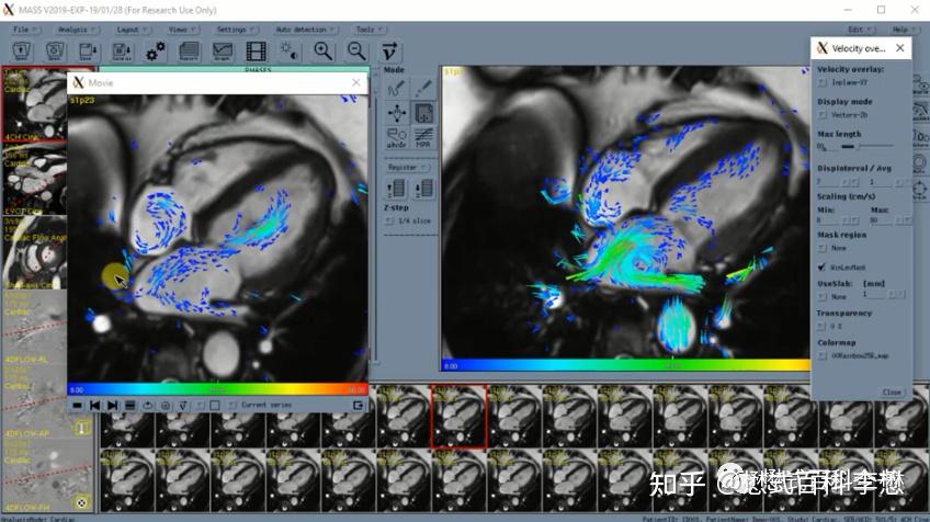 4D-Flow扫描数据采集：序列及参数 - 知乎