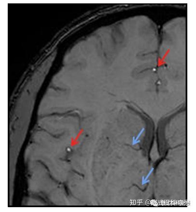 SWI序列原理及临床应用 - 知乎