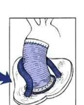 主动脉根部常见手术方式及区别，值得收藏！ - 知乎