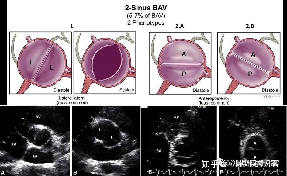二叶式主动脉瓣畸形之一 分型 - 知乎