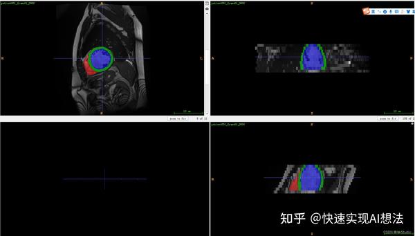 论文复现：nnformer-3d医学图像分割 - 知乎