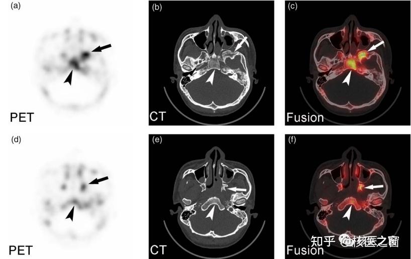 18F-NaF PET/CT助力识别“隐藏”骨骼疾病 - 知乎