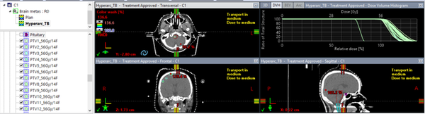 100万脑转移瘤救星【HyperArc超弧刀】——无创治疗颅内肿瘤 - 知乎