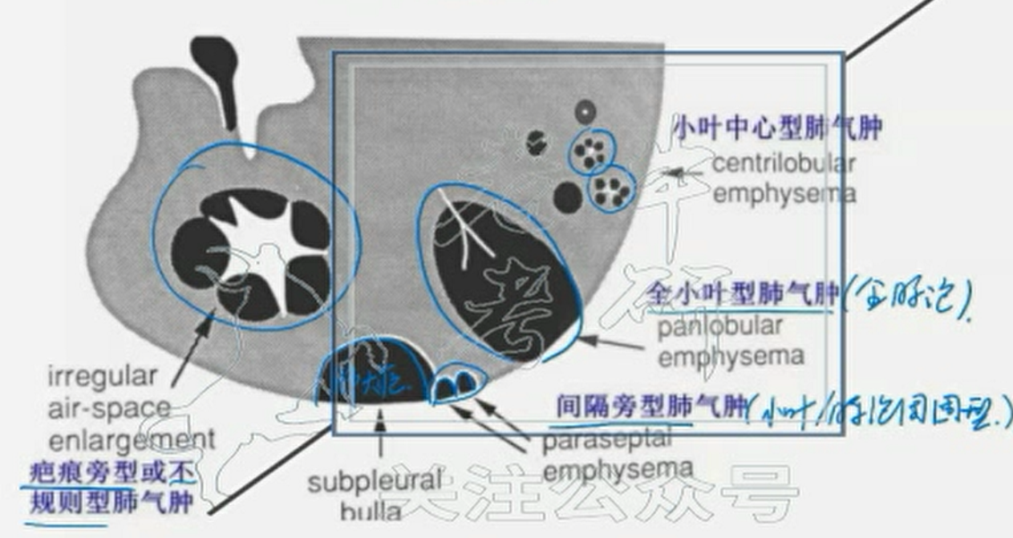 呼吸病理学：COPD系列疾病-肺气肿 - 知乎
