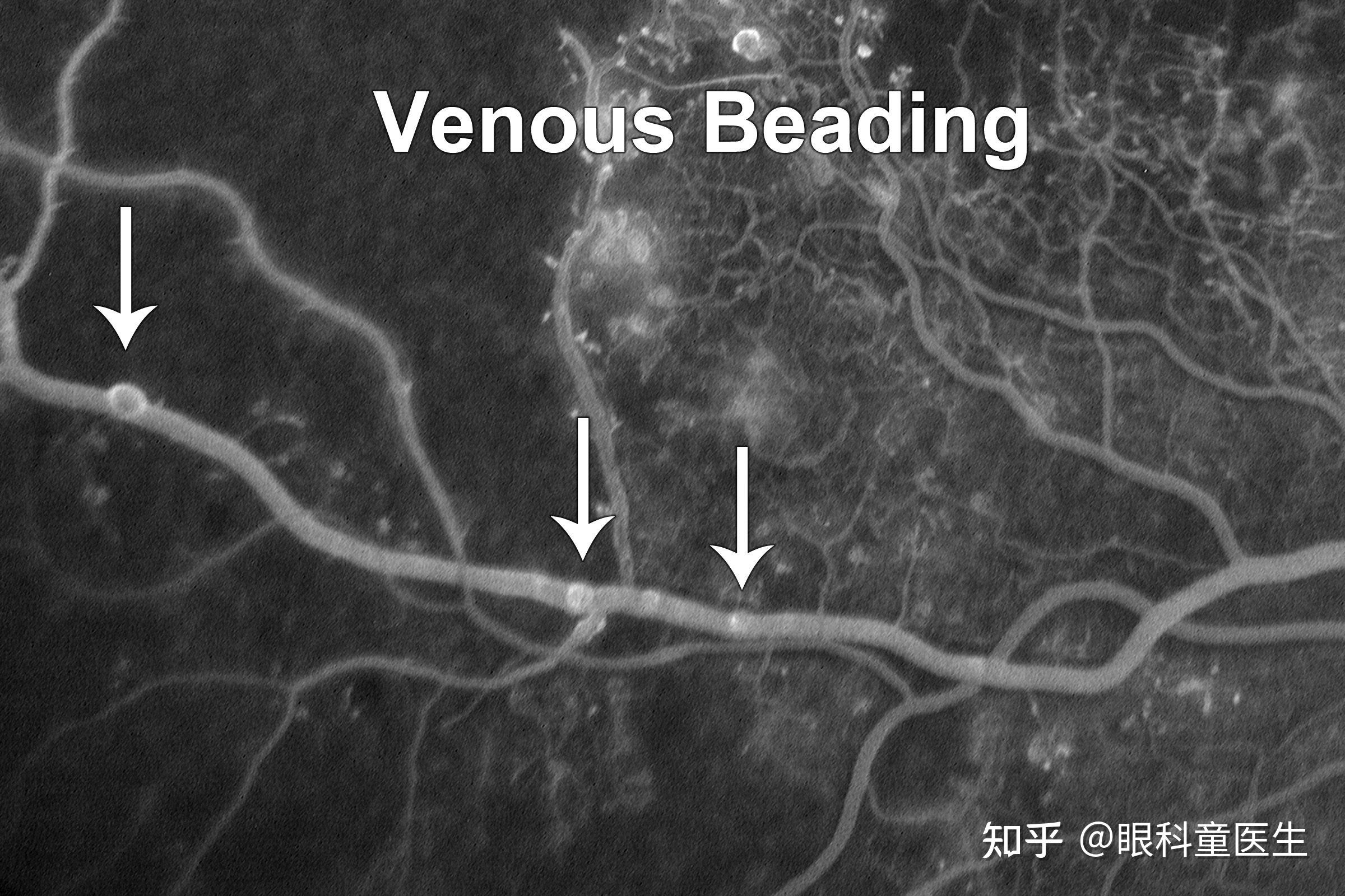 眼底彩照和眼底造影阅片 - 知乎