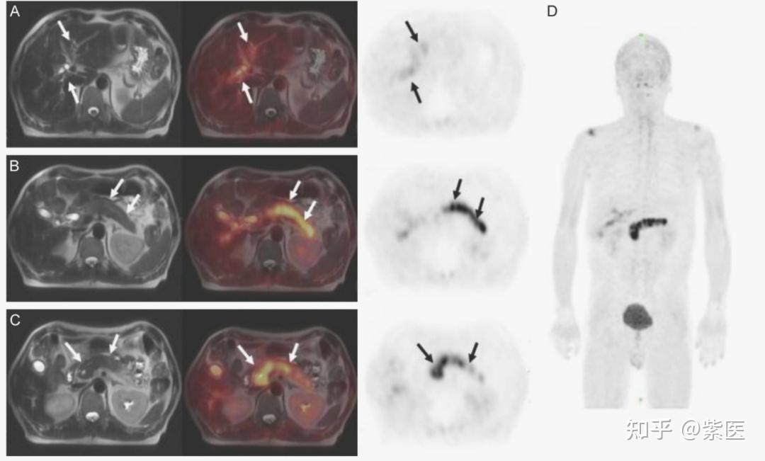 FAPI与FDG显像：恶性肿瘤评估的新旧较量 - 知乎