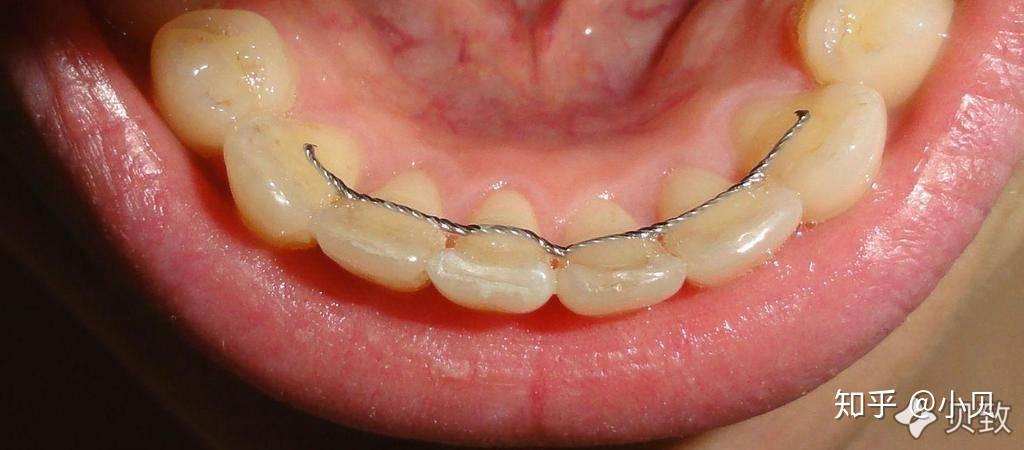 牙齿矫正后需要终身都戴保持器吗? - 知乎