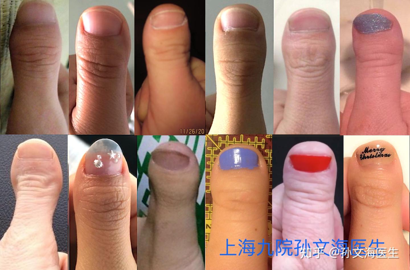 大拇指又短又宽能治疗吗? 知乎