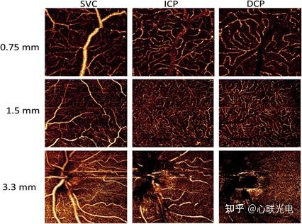 BIOMED OPT EXPRESS：利用OCTA在3秒内对视网膜中央凹旁循环进行成像 - 知乎