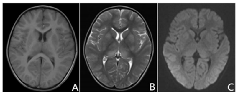 难倒大部分神内医生的MOG抗体病，8大临床表型一文掌握 - 知乎