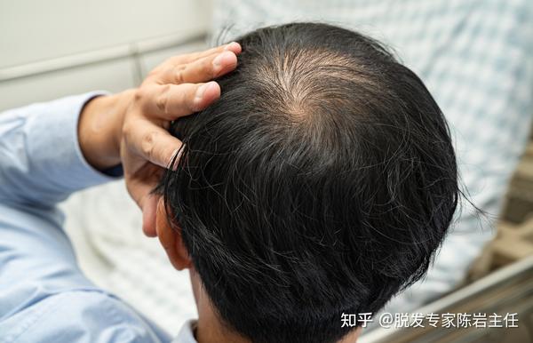 纵欲过度导致的脱发三招教您改善! 知乎