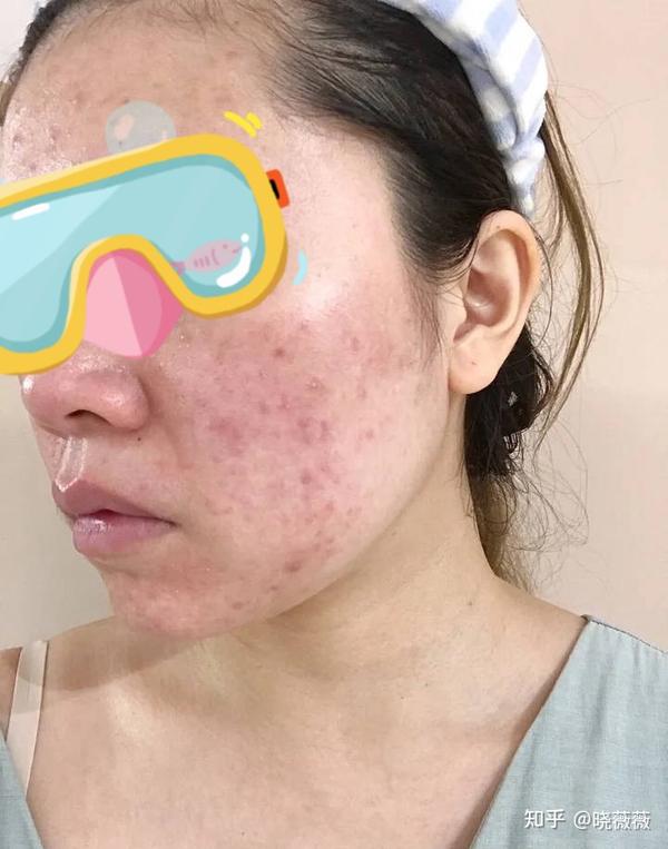 痘印一般多久会消失？真的可以自己消失吗 知乎